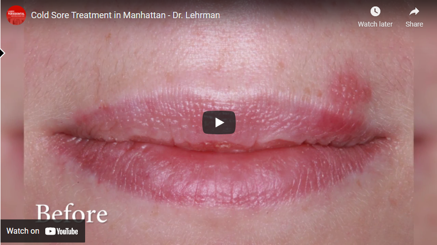 Cold Sores: Pictures, Symptoms, Causes, And Treatments, 59% OFF